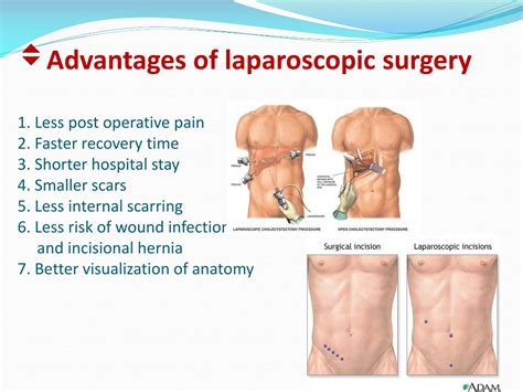 PPT - Basic principles of LAPAROSCOPIC SURGERY PowerPoint Presentation - ID:9255854