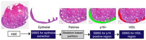 Deep Learning Based Recognition Of Cervical Squamous Interepithelial