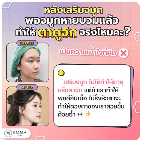 เสริมจมูกแล้วตาเปลี่ยนไหม ตาดูจิกดุขึ้น จริงหรือเปล่า