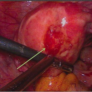 Intraoperative Image From A Year Old Female Patient Who Presented Download Scientific
