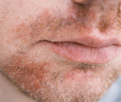 Scratch The Surface A Guide To Seborrheic Dermatitis Irish Skin