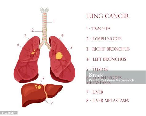 다이어그램 폐암 질환 개념 질병 인간의 내부 장기 벡터 일러스트 레이 션 만화 스타일 간 내부 기관에 대한 스톡 벡터 아트 및 기타 이미지 Istock