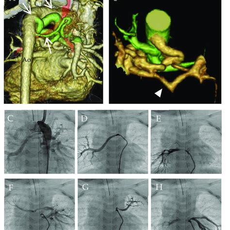 Mdct Imaging And Aortogram Of Mapca A Mapca Arrows Viewed From The