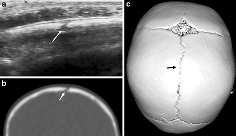 Sagittal Suture