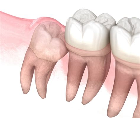 Tooth Impaction Types Symptoms And Treatment Of Impacted Teeth