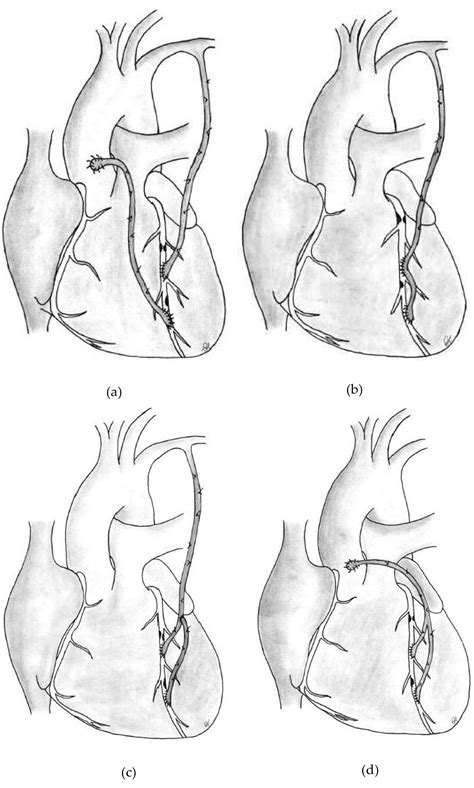 Surgical Treatment In Diffuse Coronary Artery Disease Intechopen