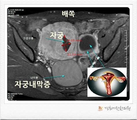 자궁내막증의 Mri정밀검사와 한방치료 28년 노하우 네이버 블로그
