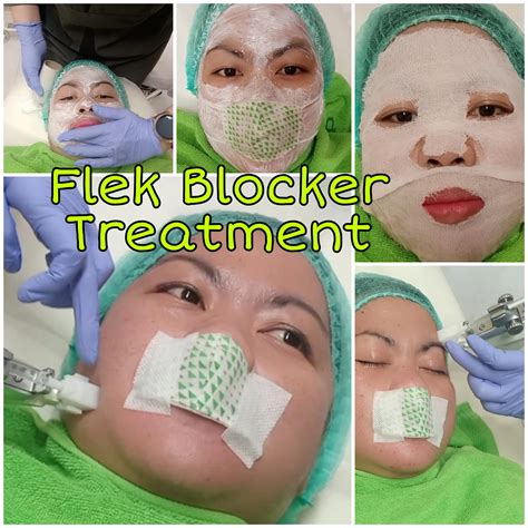 Flek Blocker Treatment Zap Clinic Ampuh Cegah Flek Hitam Usia 40 Tahun