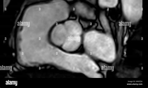 Mri Heart Or Cardiac Mri Magnetic Resonance Imaging Of Heart