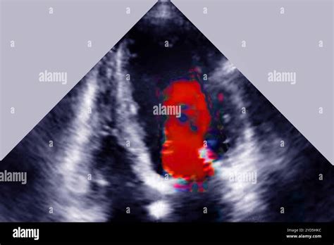 Ischemic Mitral Insufficiency Mi Pathology Of The Left Ventricle