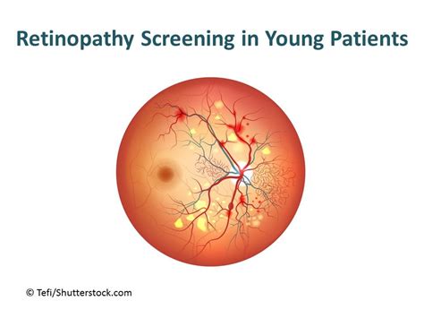 Endo News Roundup Diabetic Retinopathy Endocrinology Network