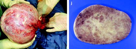 Sex Cord Stromal Tumors Radiology Key