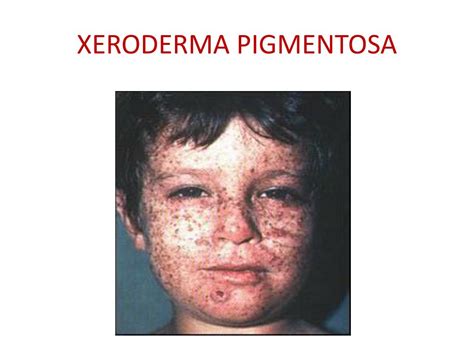 Ppt Skin Tumours Powerpoint Presentation Free Download Id2160396