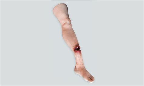 Open Fracture Leg Undefined Medical X