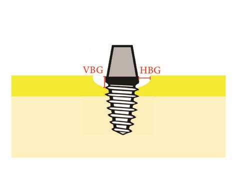 Radiographic Measurements Of Dental Implants A Platform Matched Download Scientific Diagram