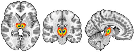 Stroke Maps