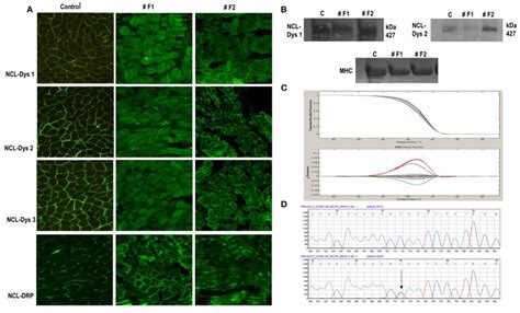 The Spectrum Of Mutations Identified In The Dmd Gene In The Group Of