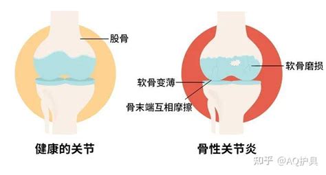 走路也可能引发运动损伤？日常步行要注意什么？ 知乎