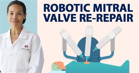 Surgeon Qanda Robotic Mitral Valve Re Repair Surgery