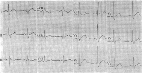 13 10 完全性右束支阻滞 心电图诊断解读