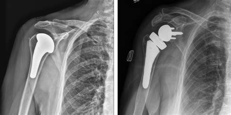 Future Frontiers In Shoulder Replacement Surgery And Management Of