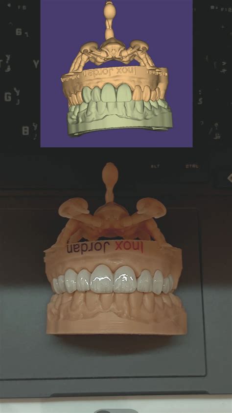 Yahya Salman On Linkedin Exocad Design