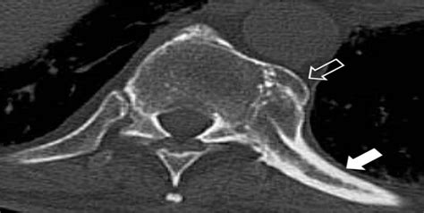 Rib Hyperostosis As A Risk Factor For Poor Prognosis In Cerv Spine