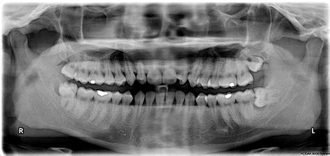 Wisdom Tooth Extraction Using Medisave