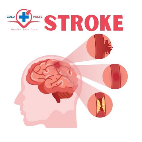 Cerebrovascular Accident Cva Or Stroke Zulu Pulse