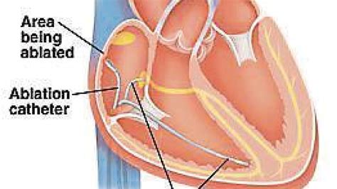 Atrial Flutter Ablation Procedure