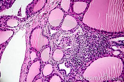 Toxic Diffuse Goiter Or Graves Disease Light Micrograph Stock Photography CartoonDealer Com