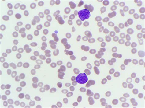 Morphology Monday 007 Hypergranular Apml Only Cells