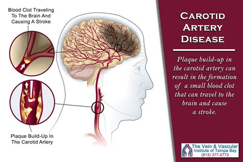 Pin On Carotid Artery Surgery In Tampa