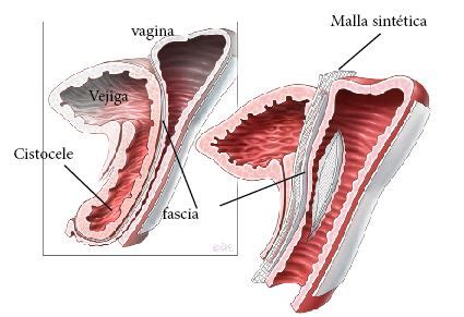 Prolapso De Vejiga Vs Prolapso Uterino