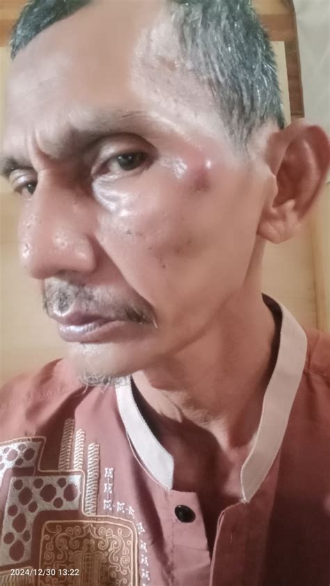 Dok Benjolan Pada Wajah Saya Apakah Berbahaya Dan Apa Nama HelloSehat