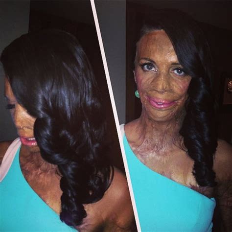 Turia Pitt Surgery And Procedures To Continue For 10 Years
