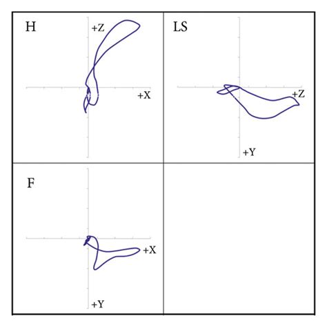 Results Of The Computer Simulation Typical LBBB Patterns Observed Download Scientific Diagram