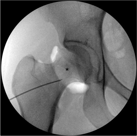 The Physics Of Postless Hip Arthroscopy Arthroscopy Techniques