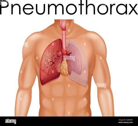 A Human Anatomy Of Pneumothorax Stock Vector Image And Art Alamy