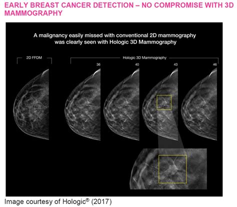 Early Breast Cancer Detection No Compromise With 3d Mammography Nia