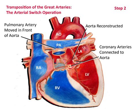 Transposition Of The Great Arteries Surgical Repair Pediatric Heart