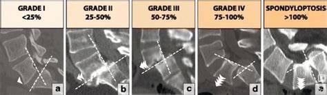 6 Easy Physical Therapy Exercises For Spondylolisthesis Correction In