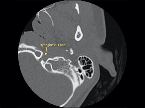 Normal Temporal Bone Ct With Annotated Images Radiopaedia 84293 99584