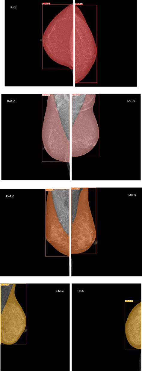 Figure 1 From An Approach To Classifying Breast Density Level Using