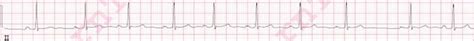 Sinus Arrhythmia ECG Review Learn The Heart