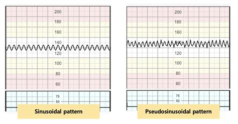 분만진통 중 태아안녕평가 1 Baseline Fetal Heart Activity 메디톡
