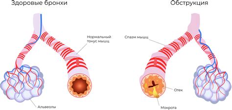 Пневмония: лечение и восстановление