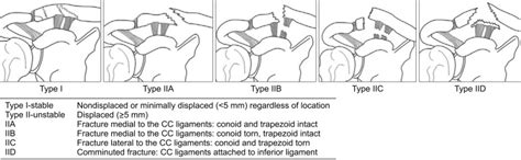 Clavicle Fracture Classification