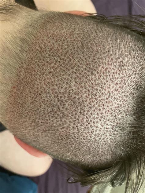 2500 Grafts Fue Week 1 Post Op Rhairtransplants