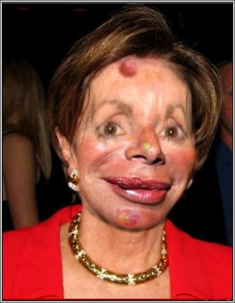 Pin By Maria A Gall On Plastic Surgeries Gone Wrong Plastic Surgery
